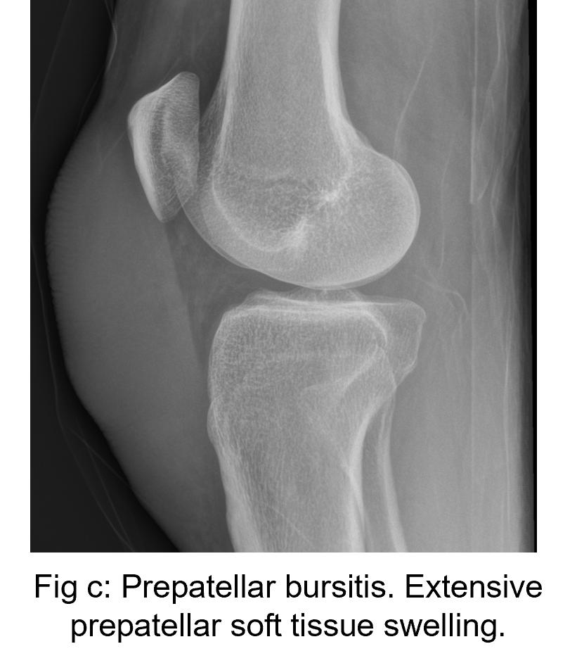 Red Hot Swollen Knee Radiology U Of U School Of Medicine